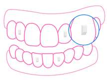 Prix de vos aligneurs dentaires invisibles | DR SMILE X Impress